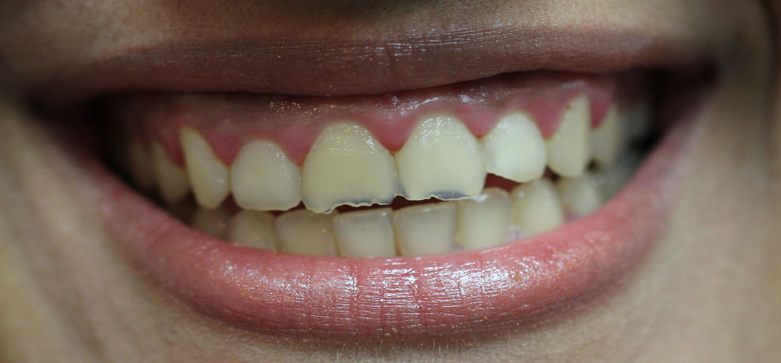 Smile Makeover - Mounir Dental Clinic